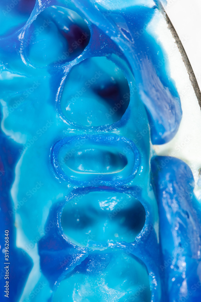 impression of a tooth after preparation under a dental crown or veneer ...