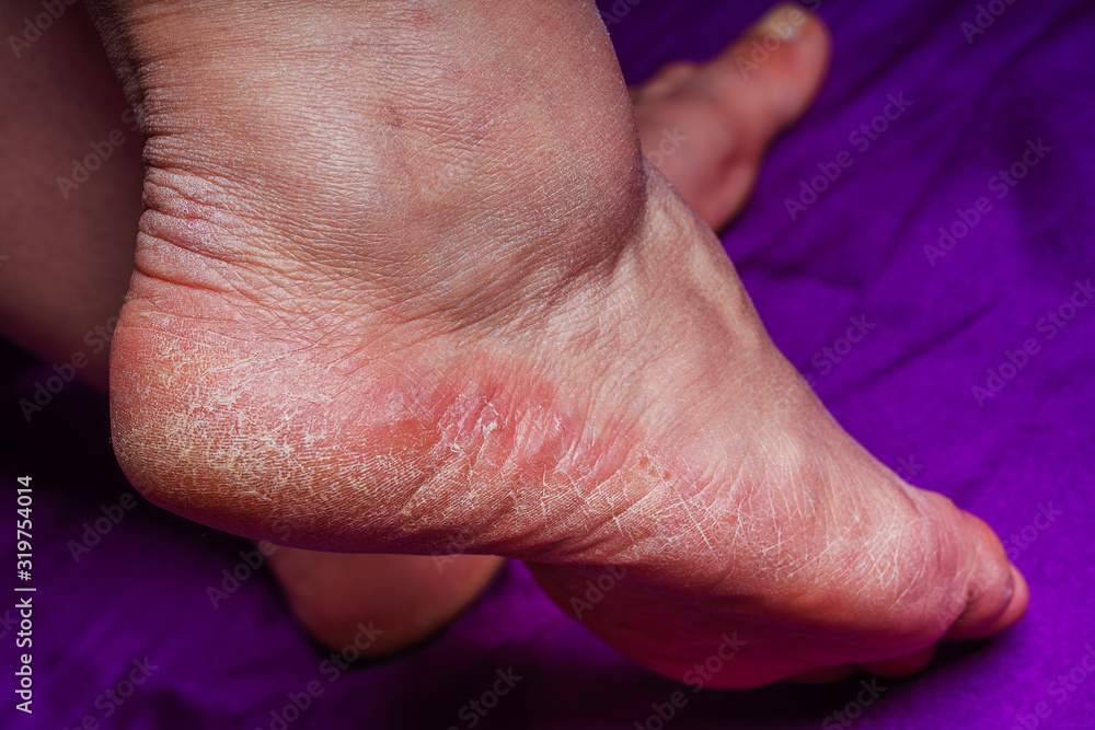 Skin allergic dermatitis redness on the foot. Old woman's legs. Cracks ...