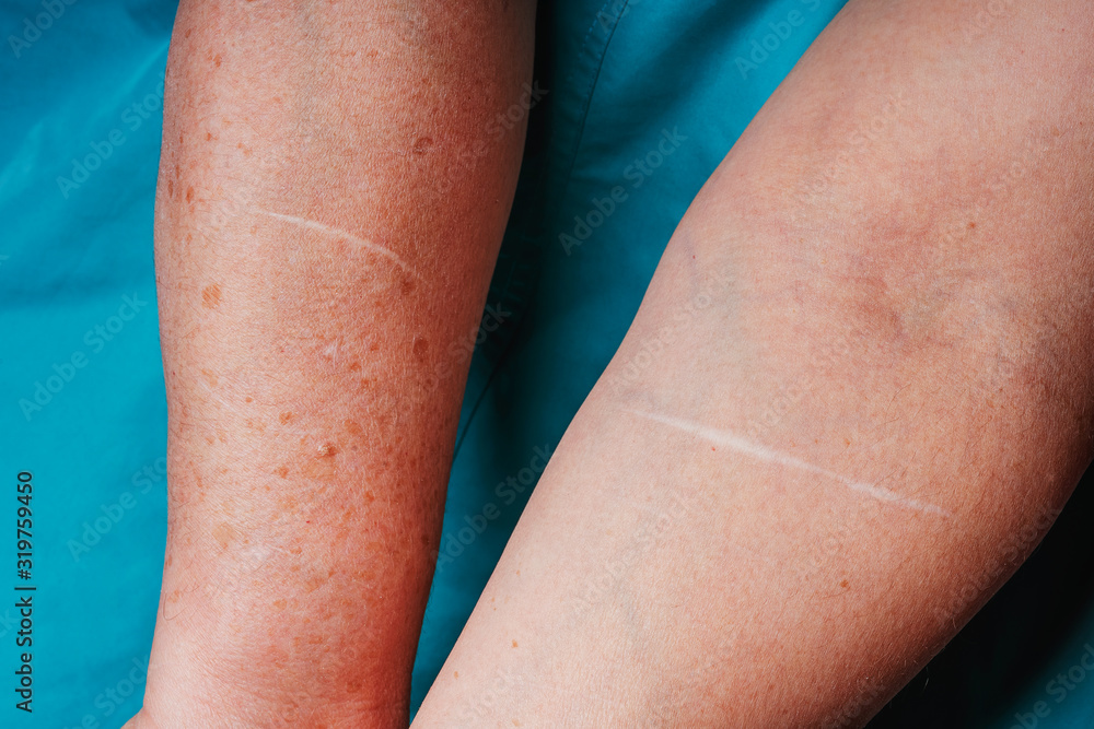 Old scars on an elderly woman's body. Scars and marks from a car crash ...