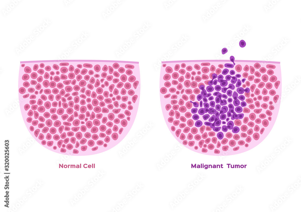 cancer; tumor; cells; malignant; stages; development; growth; anatomy ...