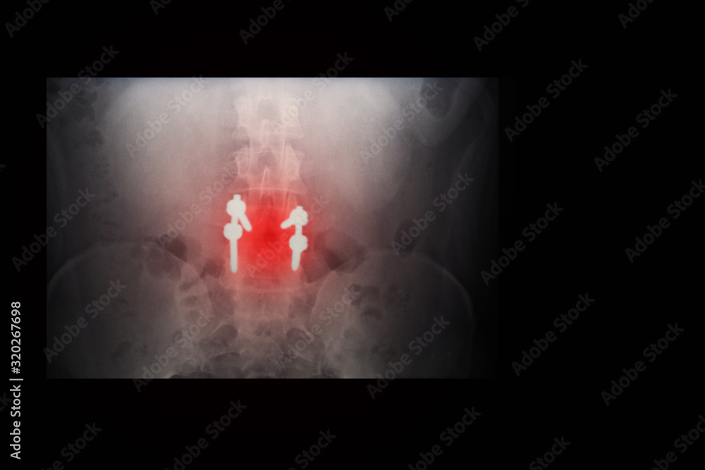 Stock-Foto „X-ray lumbar bone with fixator, spinal fracture, injury ...
