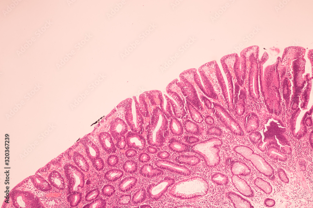 View in microscopic of ductal cell carcinoma, adenonocarcinoma from ...
