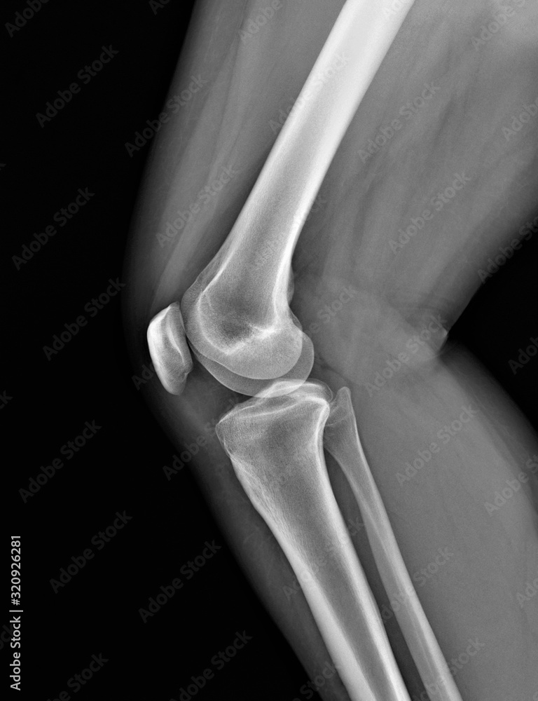 normal radiography of the knee joint in the lateral projection, medical ...