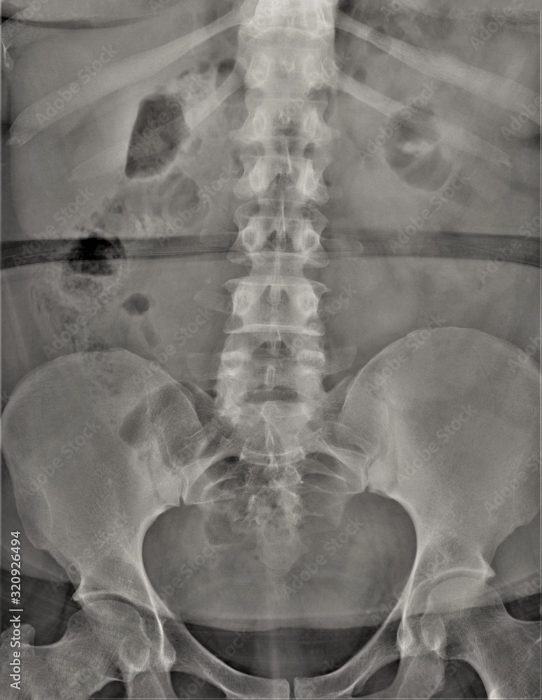 Foto de Stock x-ray of the abdominal cavity and pelvis in direct ...