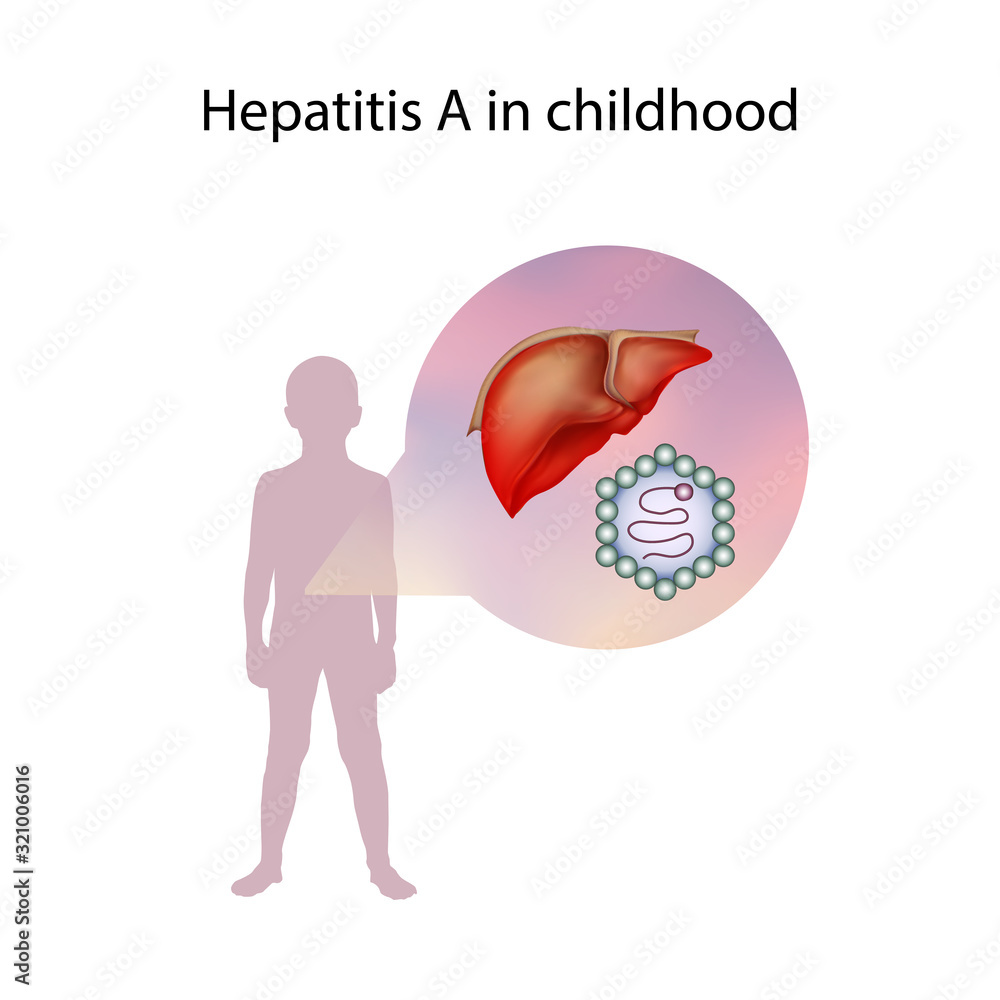 Hepatitis A in childhood. Liver inflammation. Medical anatomy ...