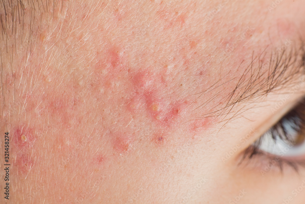 Zdjęcie bez tantiem: Pimples as a problem in an adolescent teenage boy ...