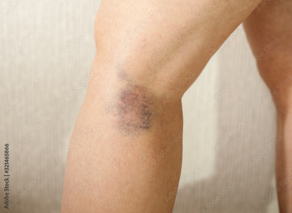 Photo Stock Dark blue, black bruise on the back of the female leg as a ...