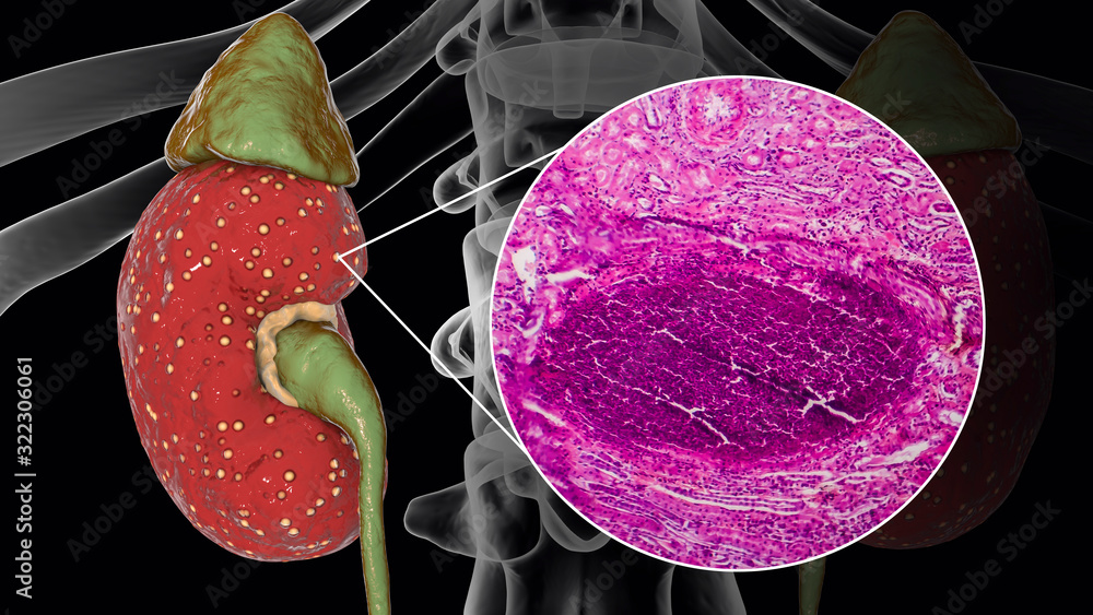 Acute pyelonephritis, gross morphology and histopathology Stock ...