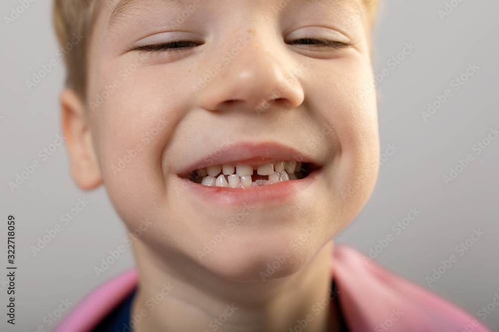 5 year old boy shows first fallen milk tooth. smiling five-year-old boy ...