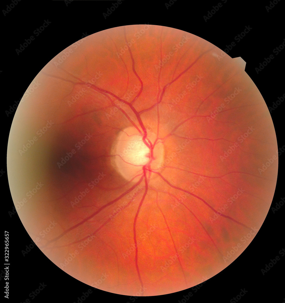 Human eye anatomy taking images with Mydriatic Retinal cameras ...