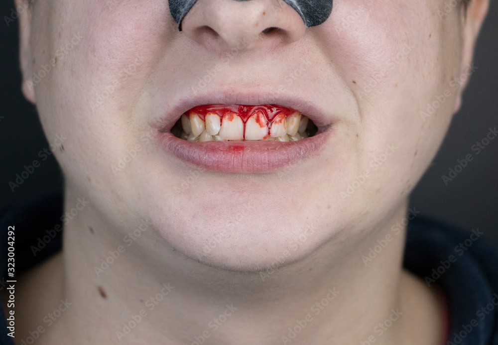 The man has blood on his teeth, severe bleeding of the gums after a ...