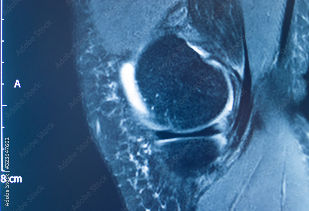 Knee injury mri mcl tear Stock Photo | Adobe Stock