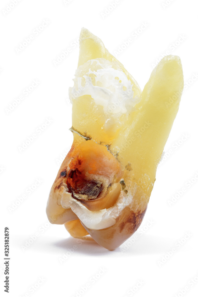 affected by caries, destroyed with a large cavity, removed human tooth ...