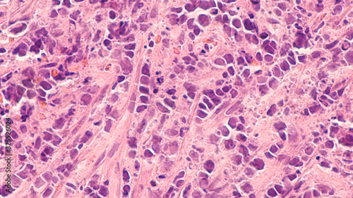 Lung Cancer Awareness; Photomicrograph of neck lymph node showing ...