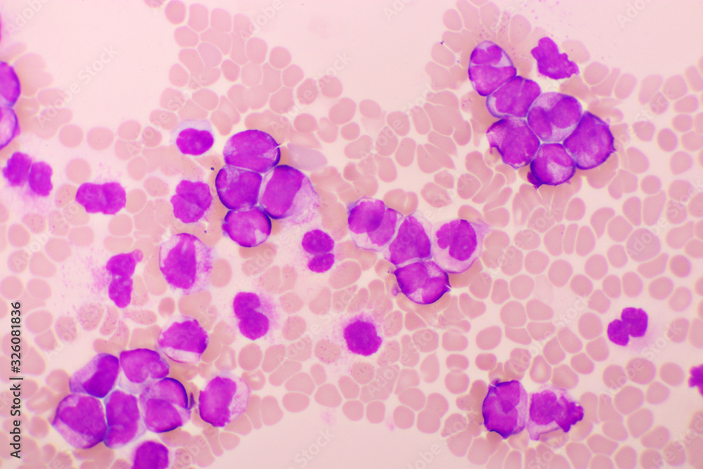 Acute promyelocytic leukemia cells or APL, analyze by microscope ...