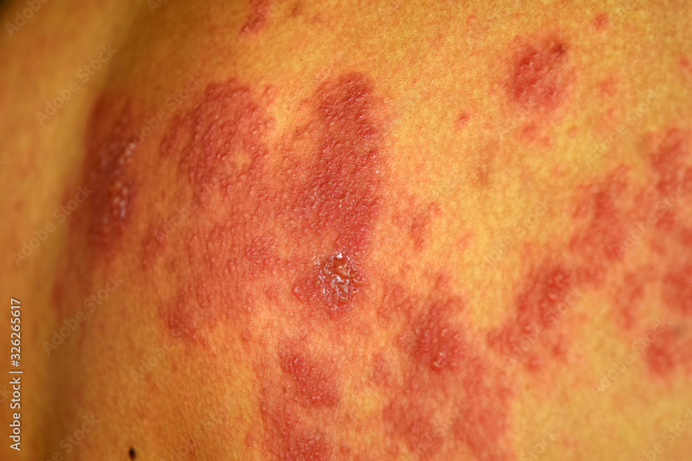Shingles (Disease),Herpes zoster, severe dermatitis due to a viral ...
