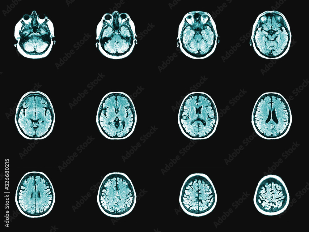 Human head and brain computer tomography image set. Horizontal ...