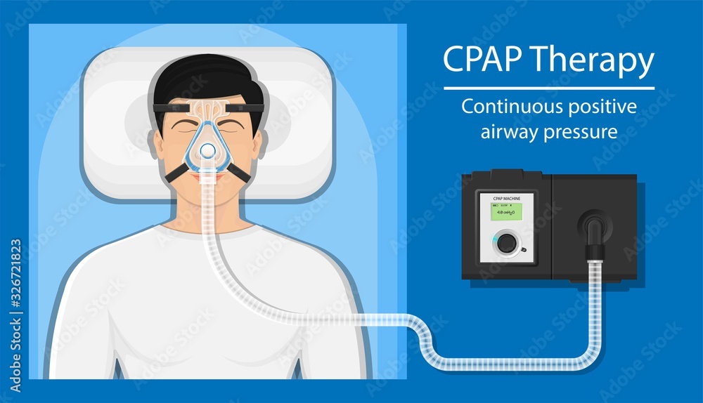 Continuous positive airway pressure (CPAP) therapy treatment ...