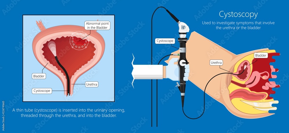 เวกเตอร์ Stock Cystoscopy diagnose bladder diseases and conditions exam ...