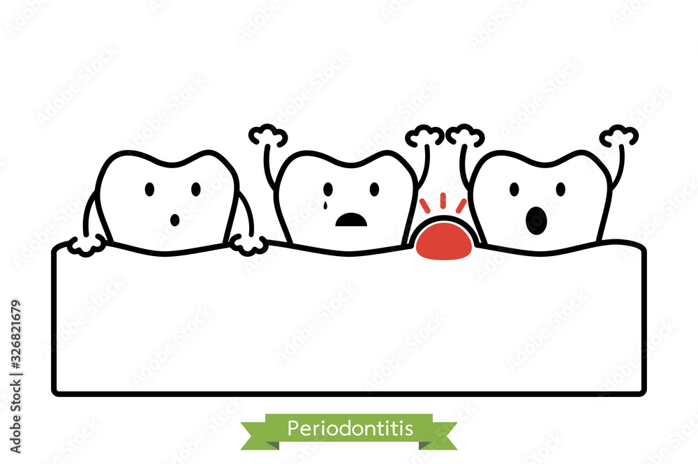 periodontitis or gum disease with swell ( gum and tooth is swollen ...