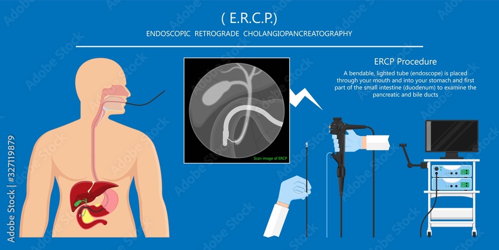 Endoscopic Retrograde Cholangiopancreatography ERCP diagnose treat ...