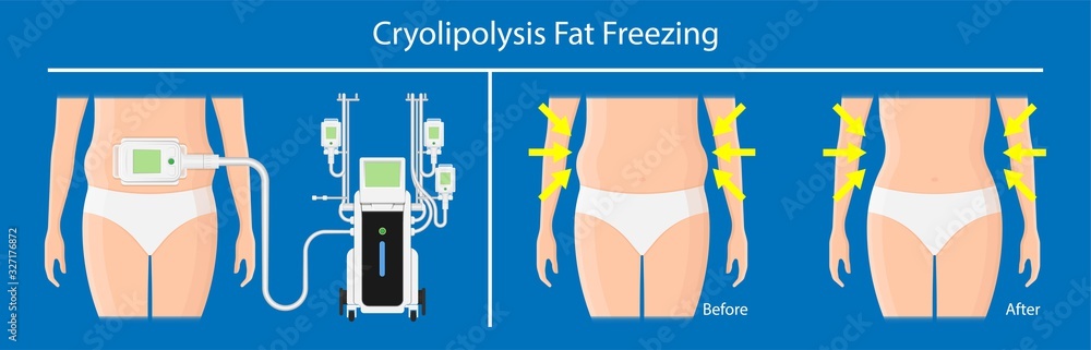 Stock-Vektorgrafik „cryolipolysis fat freezing procedure cold treatment non invasive medication ...