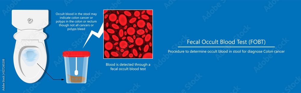 Fecal occult blood test FOBT lab stool sample bleeding screen risk ...