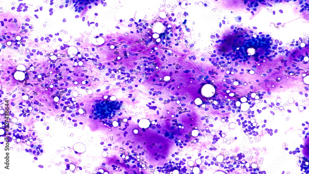 Стоковое фото «Fine needle aspiration (FNA) cytology of pleomorphic ...