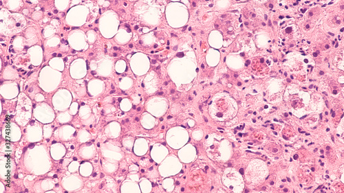 Photomicrograph of a liver core biopsy showing alcoholic liver disease ...