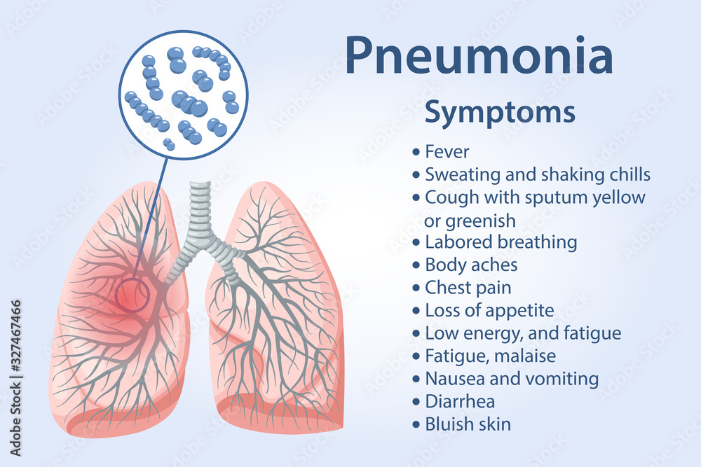 Pneumonia symptoms as text. Streptococcus pneumoniae bacteria with ...