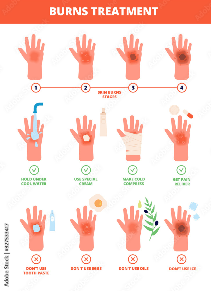 Skin burn. Burned hand treating, protection burns. First aid and ...