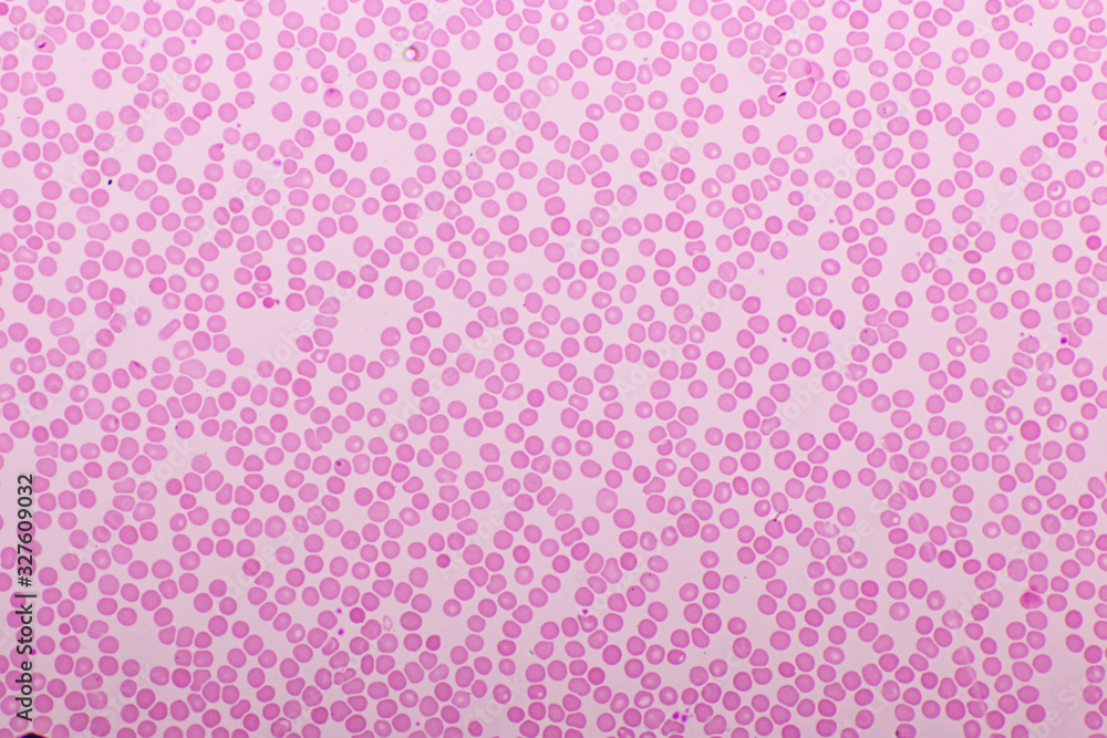 Red blood cells in blood smear, Wright-Giemsa stain, analyze by ...