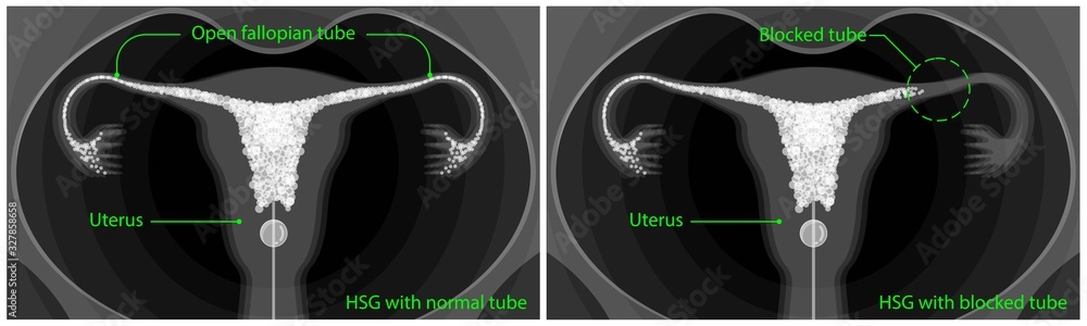 Hysterosalpingogram (HSG) Test Blocked Fallopian Tubes diagnose tubal ...