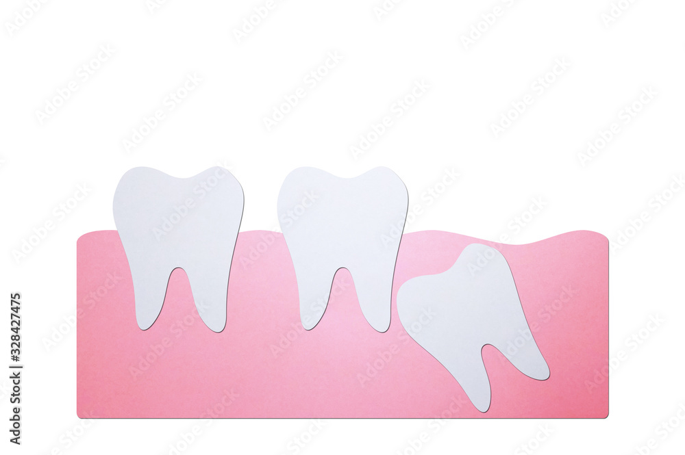 wisdom tooth ( angular or mesial impaction ) affect to other teeth ...