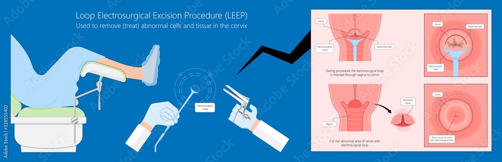 Cold knife cone biopsy Loop Electrosurgical Excision Procedure LEEP ... Cold knife cone biopsy Loop Electrosurgical Excision Procedure LEEP ...