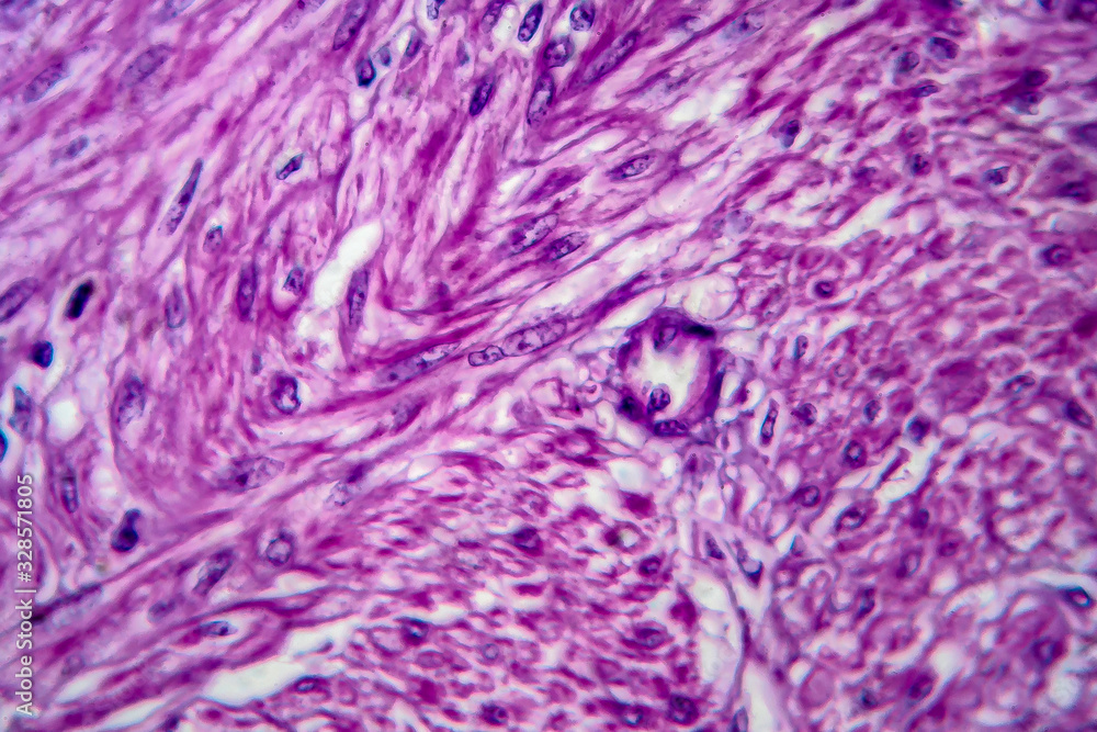 Uterine leiomyoma, also known as fibroids,a benign smooth muscle tumor ...