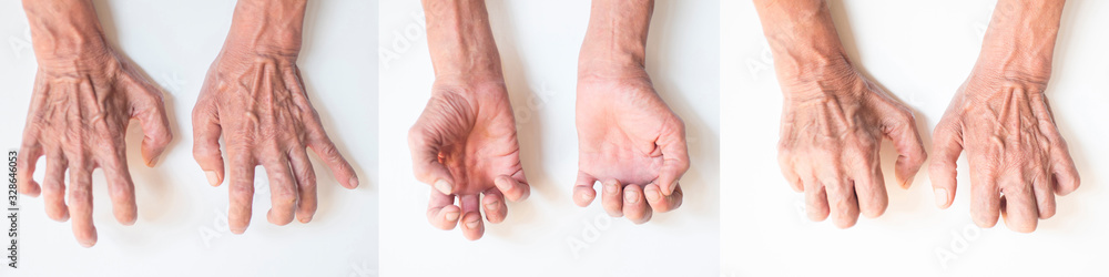 Trigger Finger a defect in a tendon causing a finger to jerk or snap ...