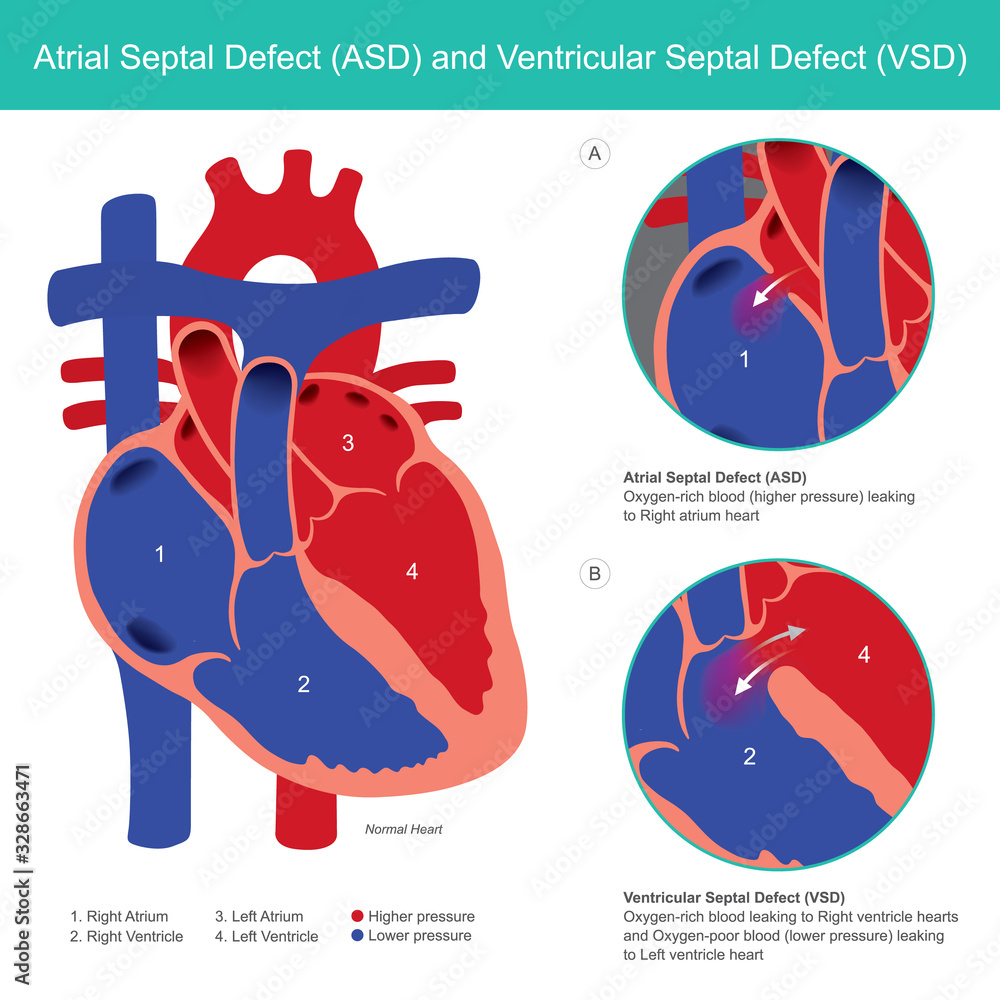 Atrial Septal Defect (ASD) and Ventricular Septal Defect (VSD ...