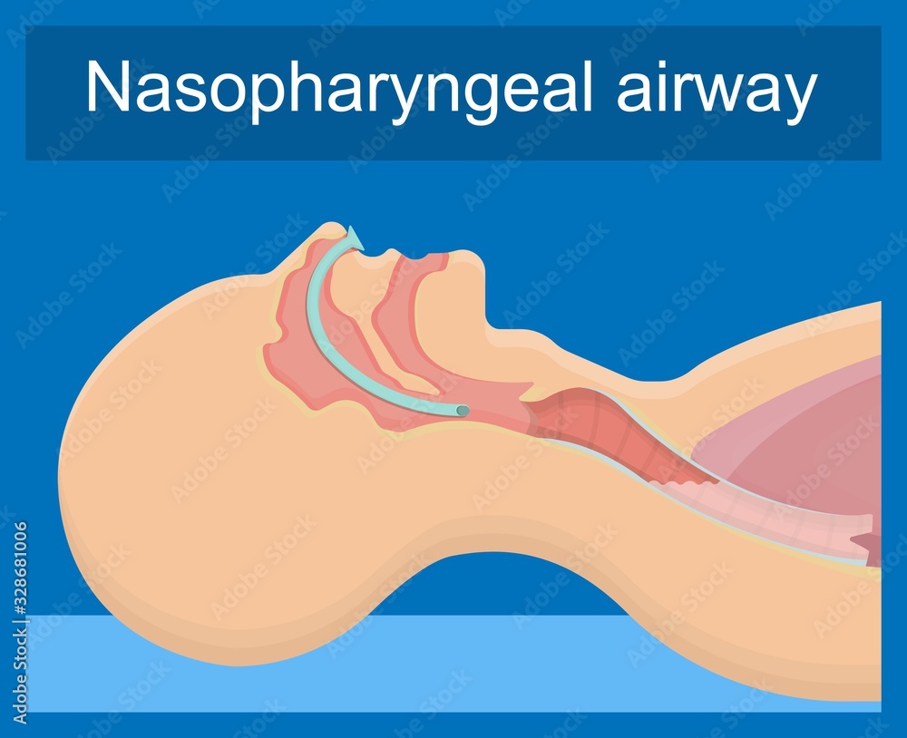 Vector de Stock Suction patient adult nares unit lung clear fluid tube ...