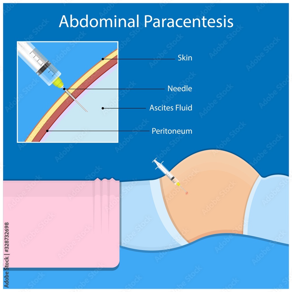 Ascites Paracentesis medical procedure diagnostic abdominal bacteria ...