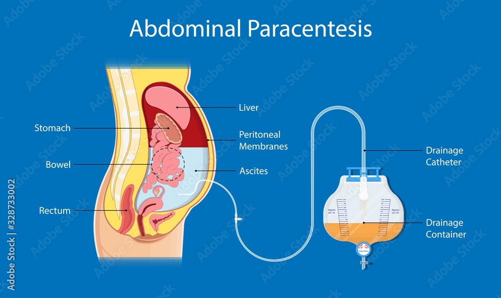 Ascites Paracentesis medical procedure diagnostic abdominal bacteria ...