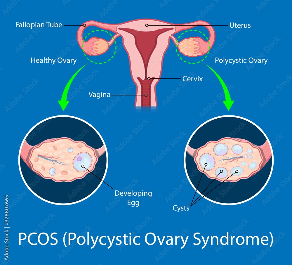 Стоковое векторное изображение «polycystic ovary syndrome PCOS hormonal ...