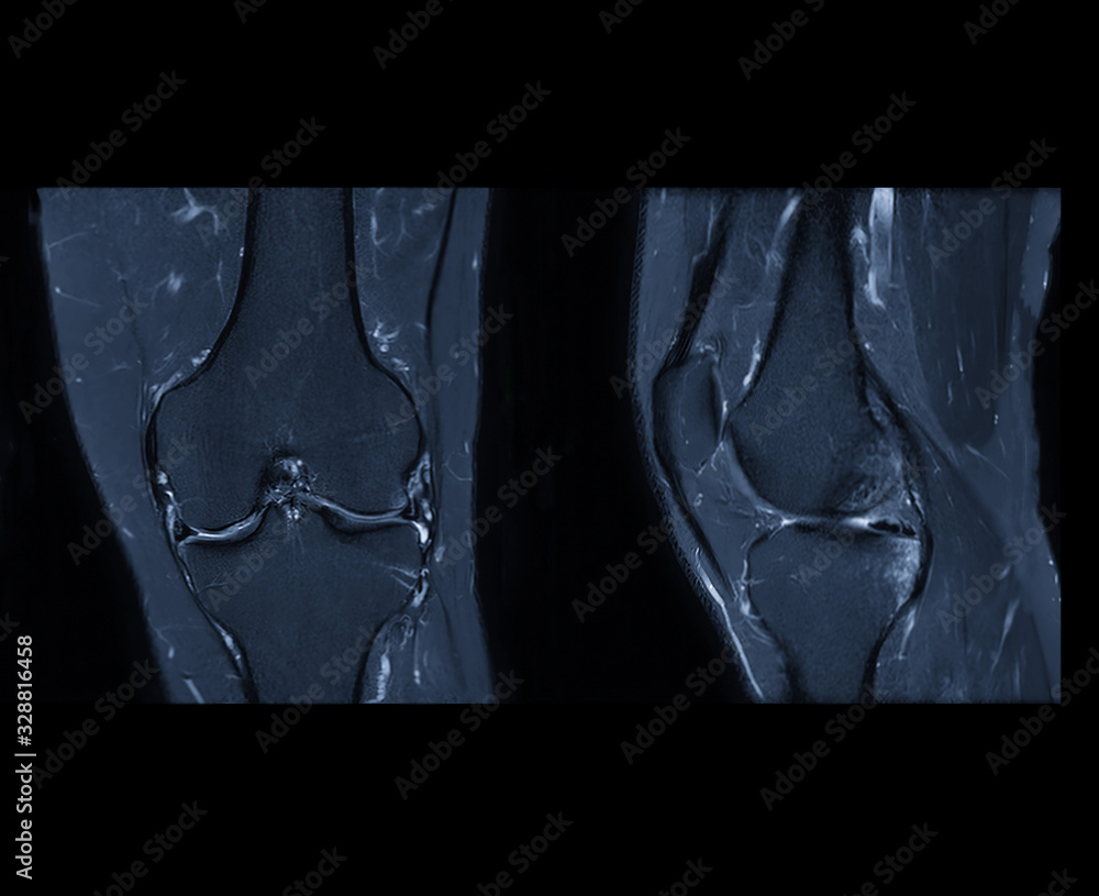 Compare of MRI knee or Magnetic resonance imaging of knee joint stir technique of axial ...