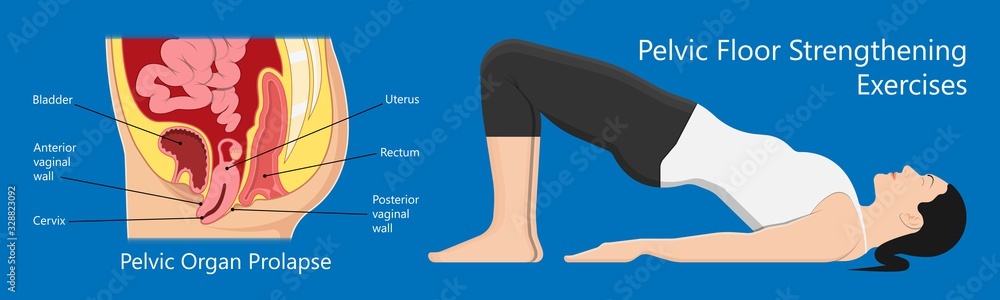 Pelvic floor prolapse type uterine uterus biofeedback pelvic floor ...