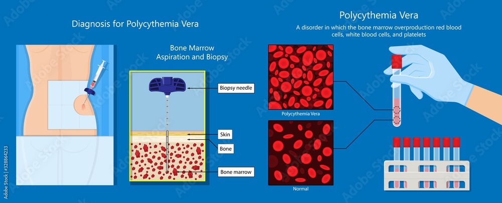 Vetor Polycythemia vera PV blood clots cancer bone marrow diagnostic ...