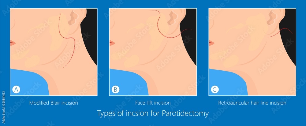 Parotid gland Sialadenitis bacterial infection Sialolithiasis blockage ...