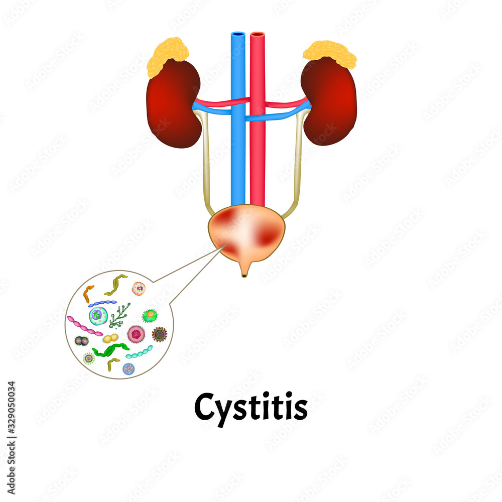 Cystitis. Inflammation of the bladder. The structure of the kidneys and ...