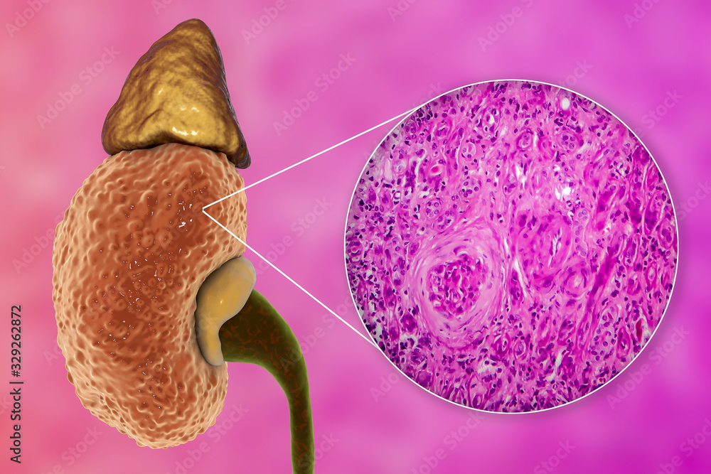Chronic glomerulonephritis, 3D illustration showing pale contracted ...