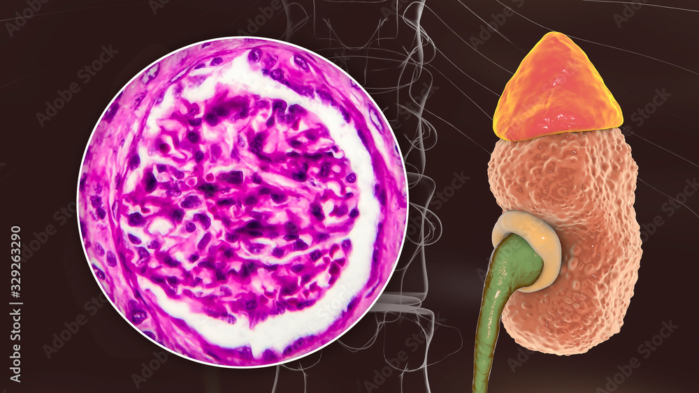 Chronic glomerulonephritis, 3D illustration showing pale contracted ...