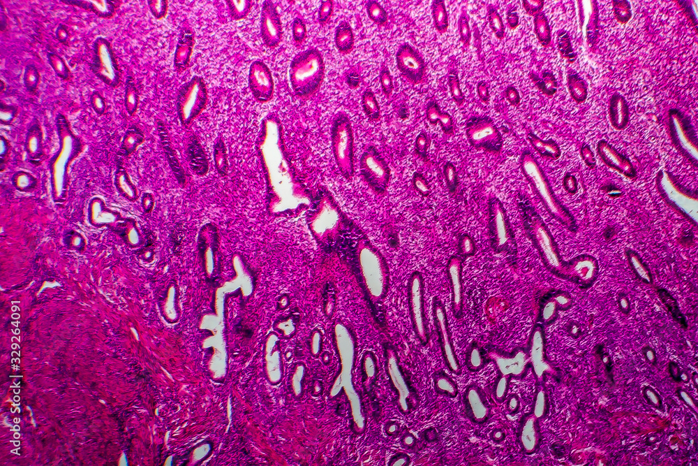 Endometrial hyperplasia, light micrograph, photo under microscope Stock ...